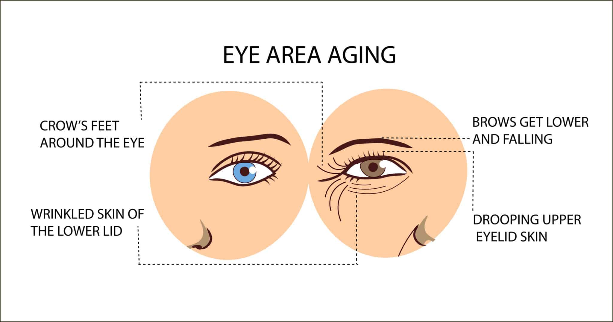 How to Get Rid of Under Eye Wrinkles (5 Proven Ways!)
