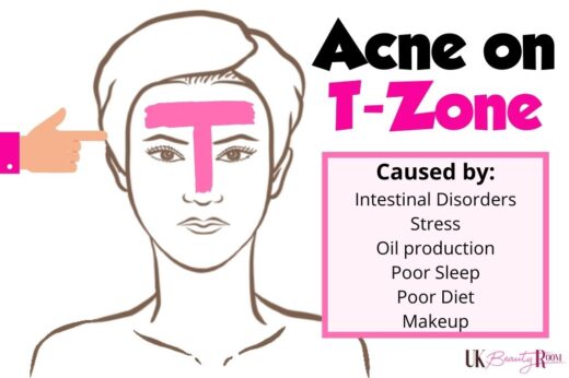 Acne Face Map: What Your Acne is Telling You About Your Health