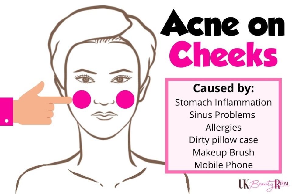 Acne Face Map: What Your Acne is Telling You About Your Health