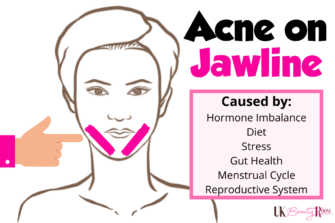 Acne Face Map: What Your Acne is Telling You About Your Health